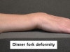 원위 요골 골절distal Radius Fracture 중년 여성이 팔을 짚으면서 넘어지면서 손목 통증이 생겼어요