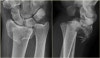 원위 요골 골절distal Radius Fracture 중년 여성이 팔을 짚으면서 넘어지면서 손목 통증이 생겼어요