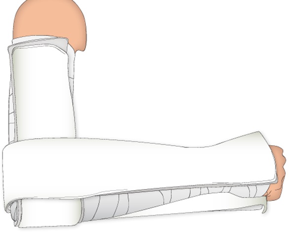 원위 요골 골절distal Radius Fracture 중년 여성이 팔을 짚으면서 넘어지면서 손목 통증이 생겼어요
