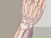 원위 요골 골절distal Radius Fracture 중년 여성이 팔을 짚으면서 넘어지면서 손목 통증이 생겼어요