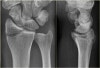 원위 요골 골절distal Radius Fracture 중년 여성이 팔을 짚으면서 넘어지면서 손목 통증이 생겼어요