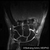 척골 충돌 증후군ulnar Impaction Syndrome 손목을 무리해서 쓴 뒤 손목의 척측에 통증이 있어요