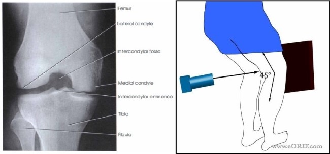 Knee X-ray의 Anatomy와 Positioning : 네이버 블로그