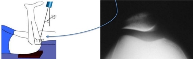 Knee X-ray의 Anatomy와 Positioning : 네이버 블로그