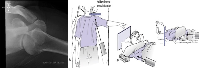 Shoulder X-ray의 Anatomy와 Positioning : 네이버 블로그