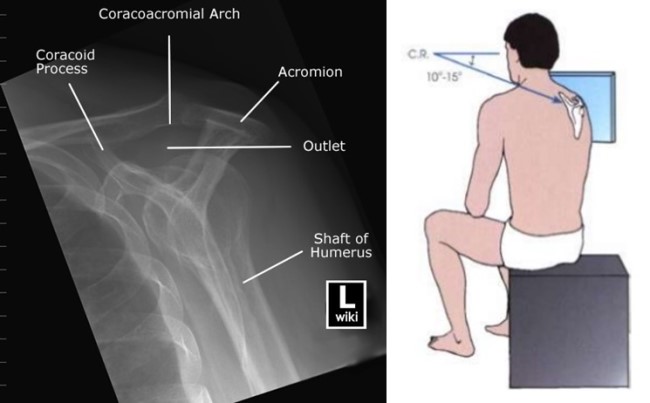 Shoulder X-ray의 Anatomy와 Positioning : 네이버 블로그