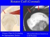 회전근개rotator Cuff의 Mri 소견 네이버 블로그