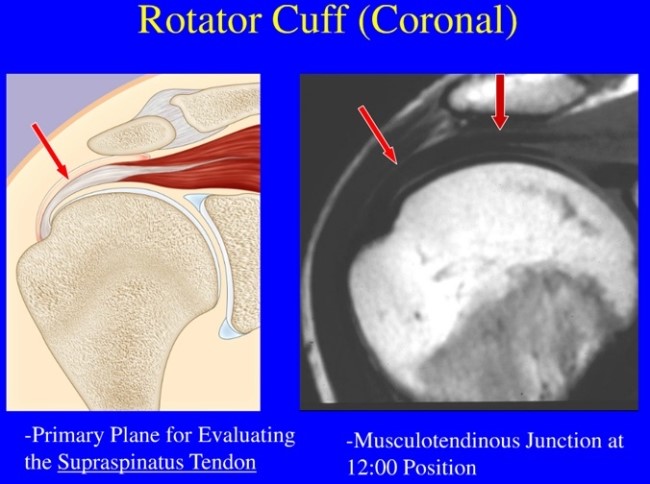 회전근개rotator Cuff의 Mri 소견 네이버 블로그
