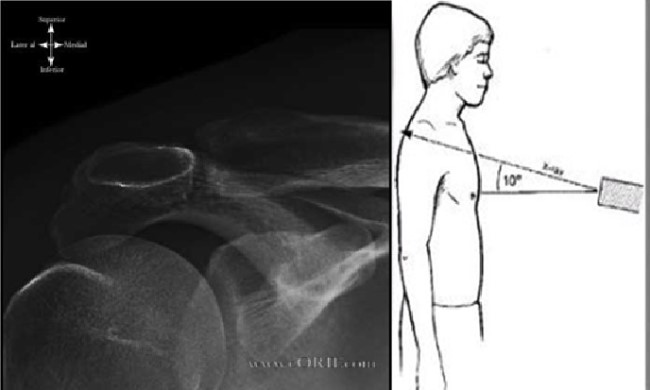 Shoulder X-ray의 Anatomy와 Positioning : 네이버 블로그