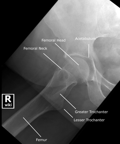 Hip X-ray의 Systemic approach : 네이버 블로그