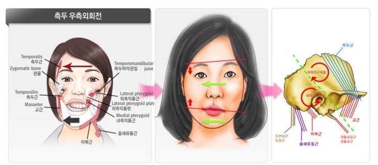 얼굴 비대칭 안면 비대칭의 종류와 치료 방법 순천 여수 광양 안면 얼굴 비대칭 턱관절 교정 포바즈 다우 한의원