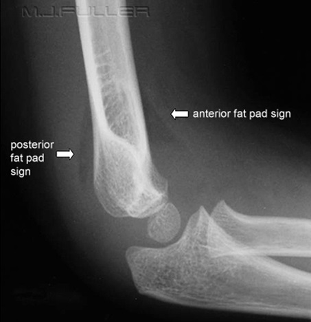 Elbow X-ray의 Fat pad sign : 네이버 블로그