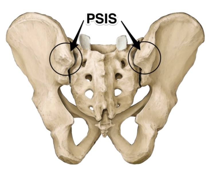 [동탄피티/동탄퍼스널트레이닝] 골반 불균형 알아보기! (ASIS/PSIS) : 네이버 블로그