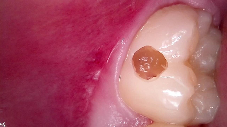 [일원동 치과 전문의] 서울 삼성치과 buccal pit caries 구치부 협면 소와 우식 : 네이버 블로그
