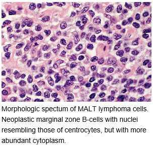 mucosa-associated lymphoid tissue(MALT) lymphoma : 네이버 블로그