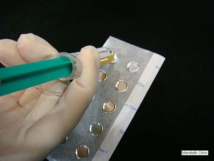 한국에 흔한 피부질환 [개정판] - 제3장 알레르기접촉피부염 - 진단 - (4) 첩포검사(patch test) - B. 핀체임버 ...