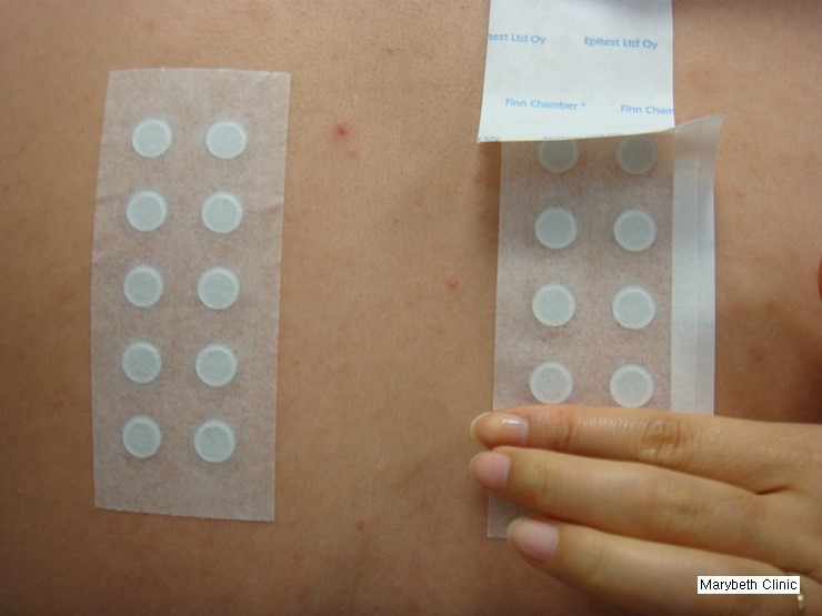 한국에 흔한 피부질환 [개정판] - 제3장 알레르기접촉피부염 - 진단 - (4) 첩포검사(patch test) - B. 핀체임버 ...