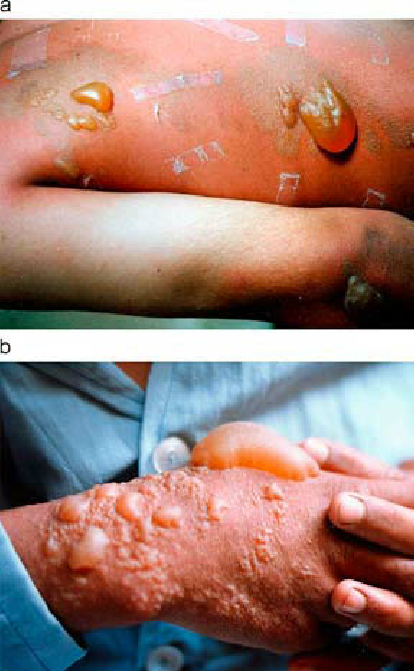 제1차세계대전때쓰인 생화학무기 : 네이버 블로그