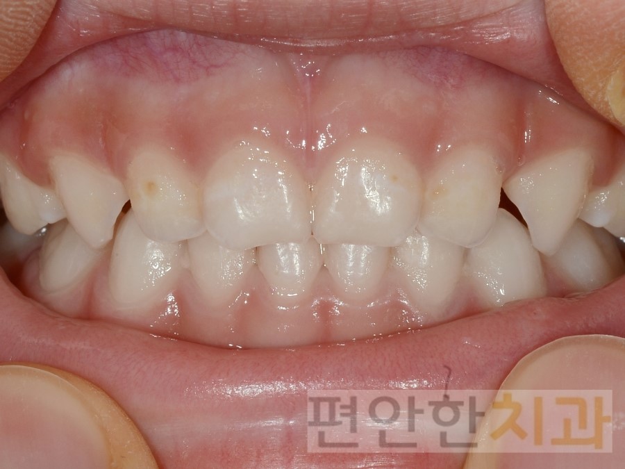 우리 아기 앞니가 까맣게 변했어요 우유병 우식증 네이버 블로그