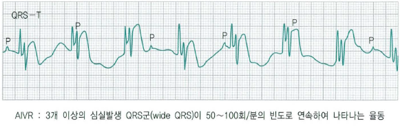 Accelerated idioventricular rhythm (AIVR): 재관류(reperfusion) 증거 : 네이버 블로그