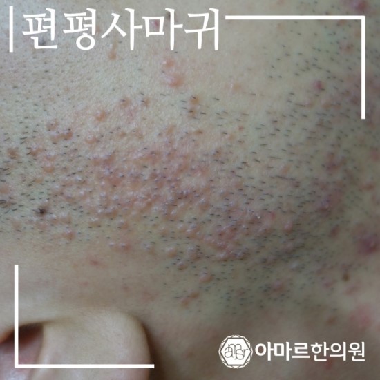 편평사마귀치료 얼굴 팔다리를 말끔하게 하려면 네이버 블로그