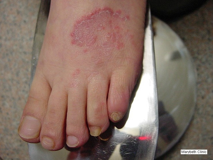 한국에 흔한 피부질환 [개정판] - 제12장. 백선증(白癬症, Dermatophytosis) - 5. 발백선증(足部白癬 ...