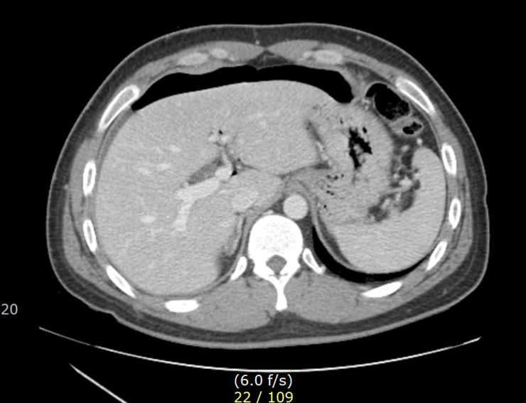 GS case - duodenal ulcer perforation, Chest PA free air [외과 파견] : 네이버 블로그