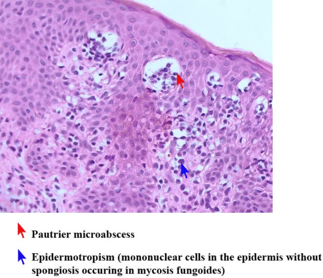 mycosis fungoides, lymphoma : 네이버 블로그