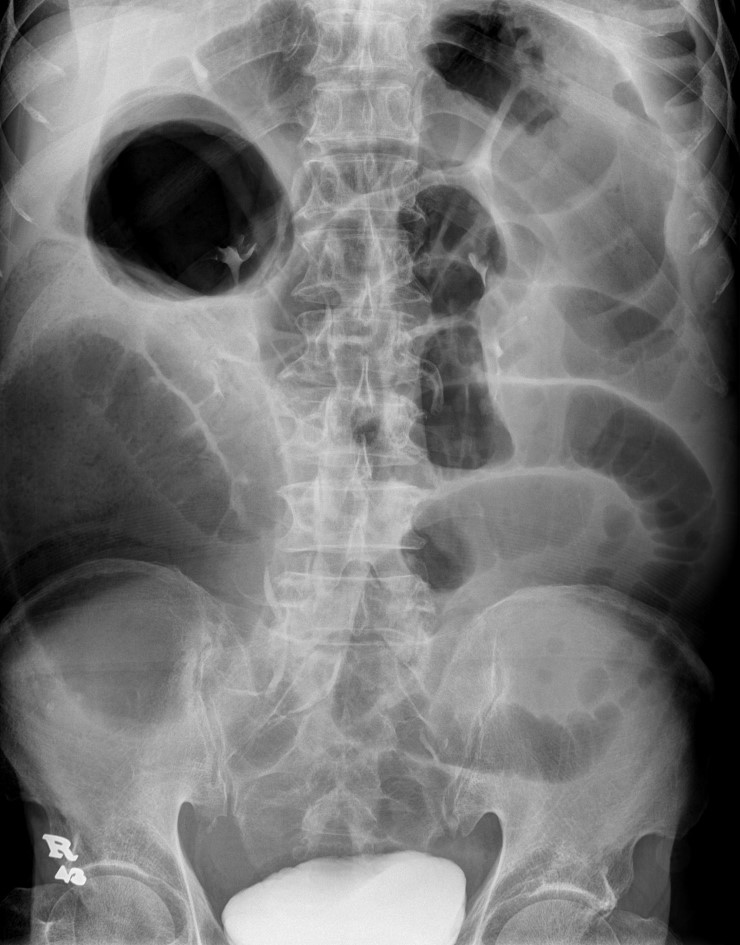 sigmoid volvulus 장염전 응급 대장폐색 내시경 / 수술적 감압 [외과 파견 / GS case] : 네이버 블로그