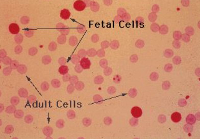 Kleihauer-Betke test : 네이버 블로그