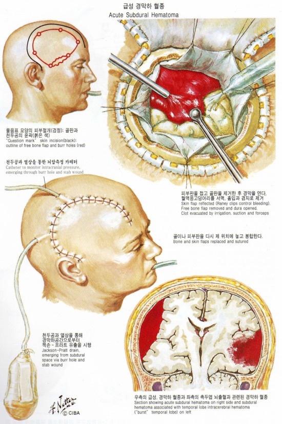 뇌 혈관질환, 두개내출혈, edh, sdh, sah 수술 : 네이버 블로그