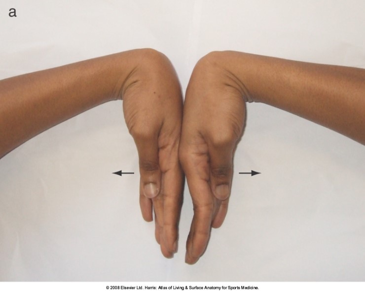 팔렌 테스트 (phalen test) - 수근관증후군(carpal tunnel syndrome) 진단 검사 : 네이버 블로그