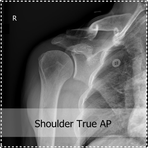 Shoulder True AP : 네이버 블로그