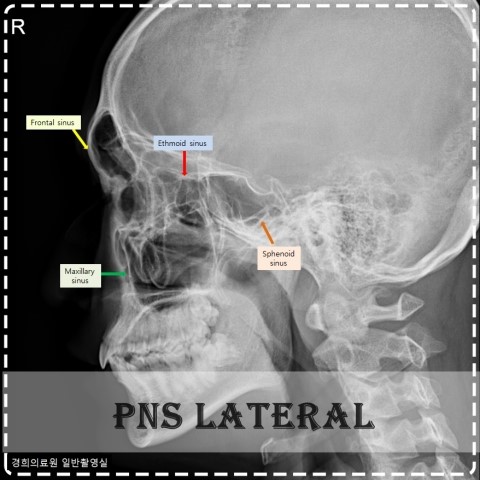 PNS Lateral : 네이버 블로그