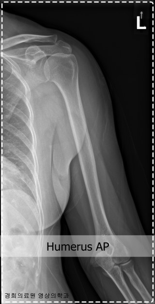 Humerus Series : 네이버 블로그