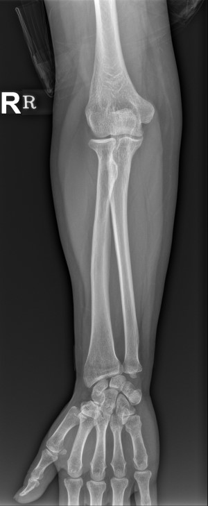 Forearm Series : 네이버 블로그