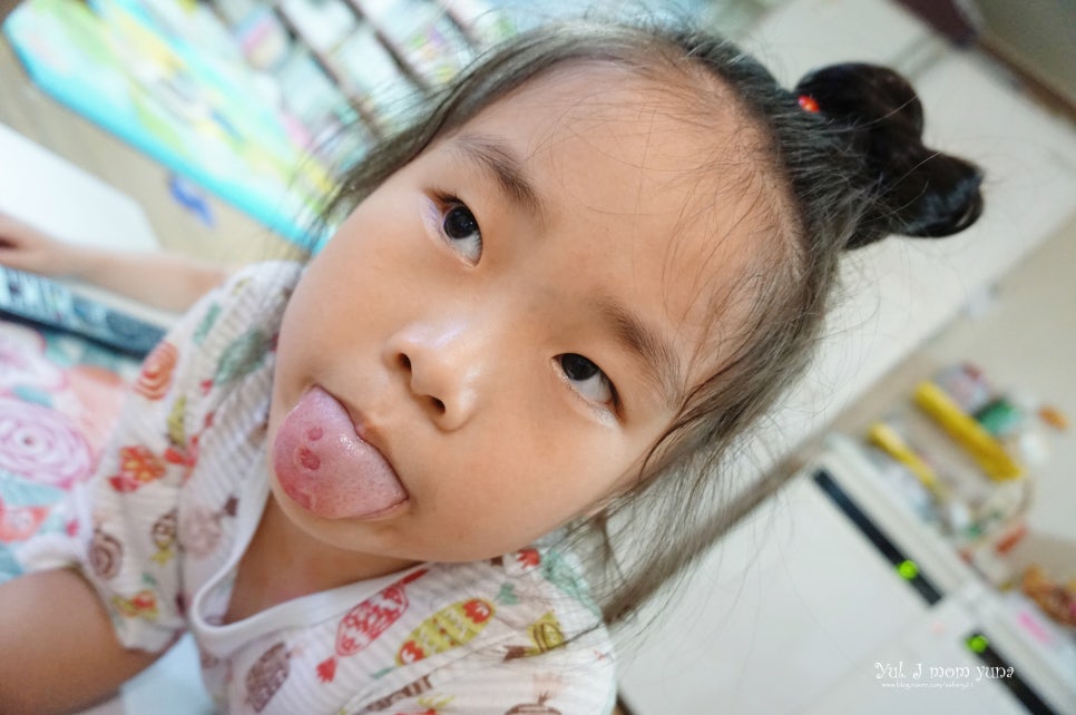 혀에 동그란 붉은반점 지도상 혀 특별한 치료없이 완쾌가능 네이버 블로그