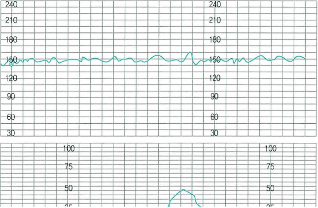 비수축검사(태동검사, Nonstress Test, NST) : 네이버 블로그