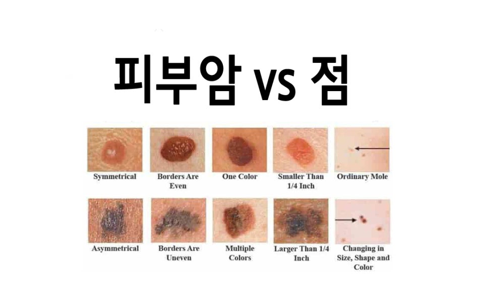 피부암 초기증상 점과 구별 사진으로 알아보자 네이버 블로그