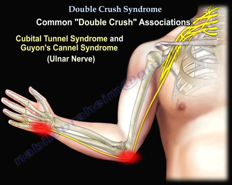 The double crush in nerve entrapment syndromes : 네이버 블로그