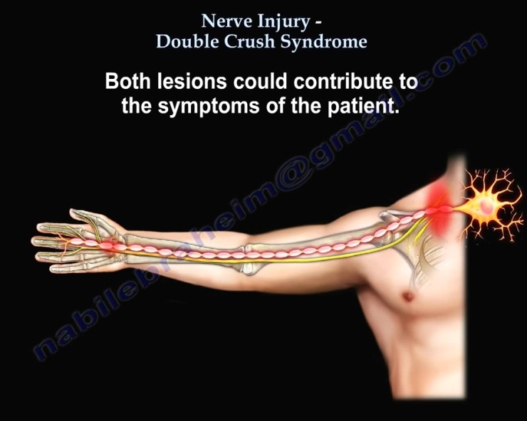 The double crush in nerve entrapment syndromes : 네이버 블로그