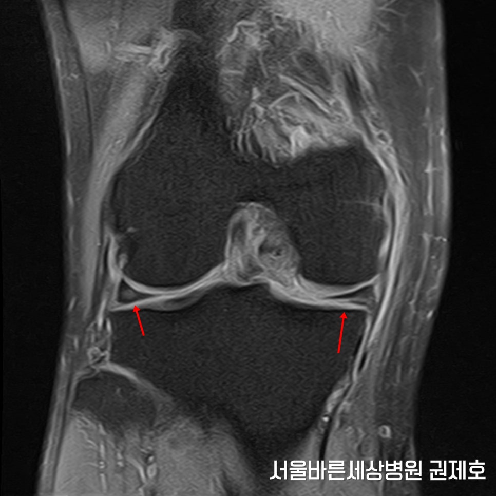 반월상연골판파열 관절경적 연골판절제술 로 해결 네이버 블로그