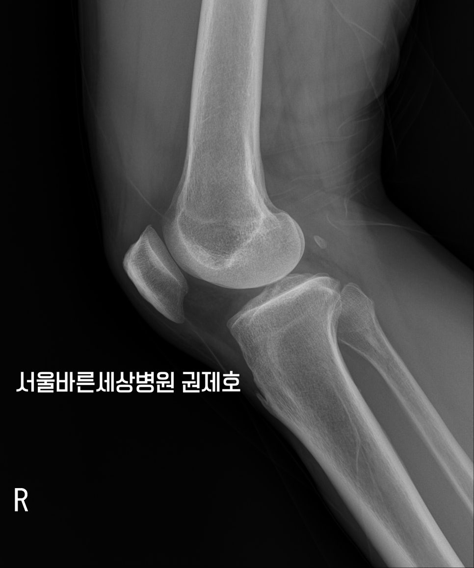 반월상연골판파열 관절경적 연골판절제술 로 해결 네이버 블로그