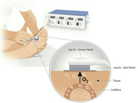 경피적 산소 분압 측정(Transcutaneous oximetry, TcPO2) : 네이버 블로그