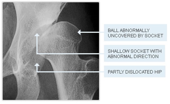 발달성 고관절 이형성증(Developmental dysplasia of the hip : DDH) : 어린 아이가 양쪽 다리 ...