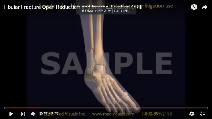 ORIF [open reduction internal fixation] : 네이버 블로그