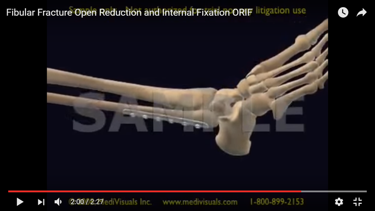 ORIF [open reduction internal fixation] : 네이버 블로그