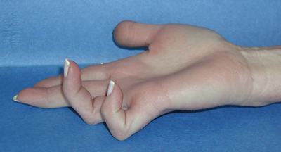 갈퀴손가락(Claw finger: Intrinsic minus hand) : 네이버 블로그