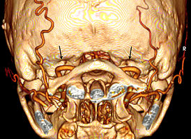 emissary veins 도출정맥 이끌정맥 : 네이버 블로그