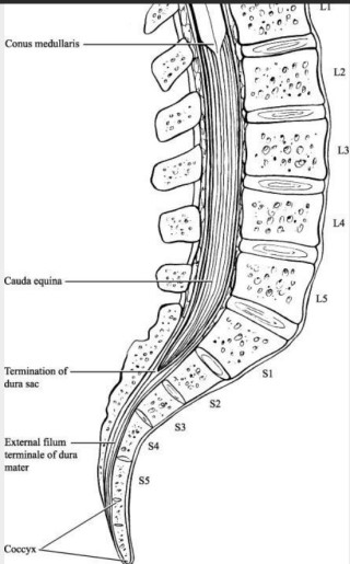 conus medullaris syndrome : 네이버 블로그